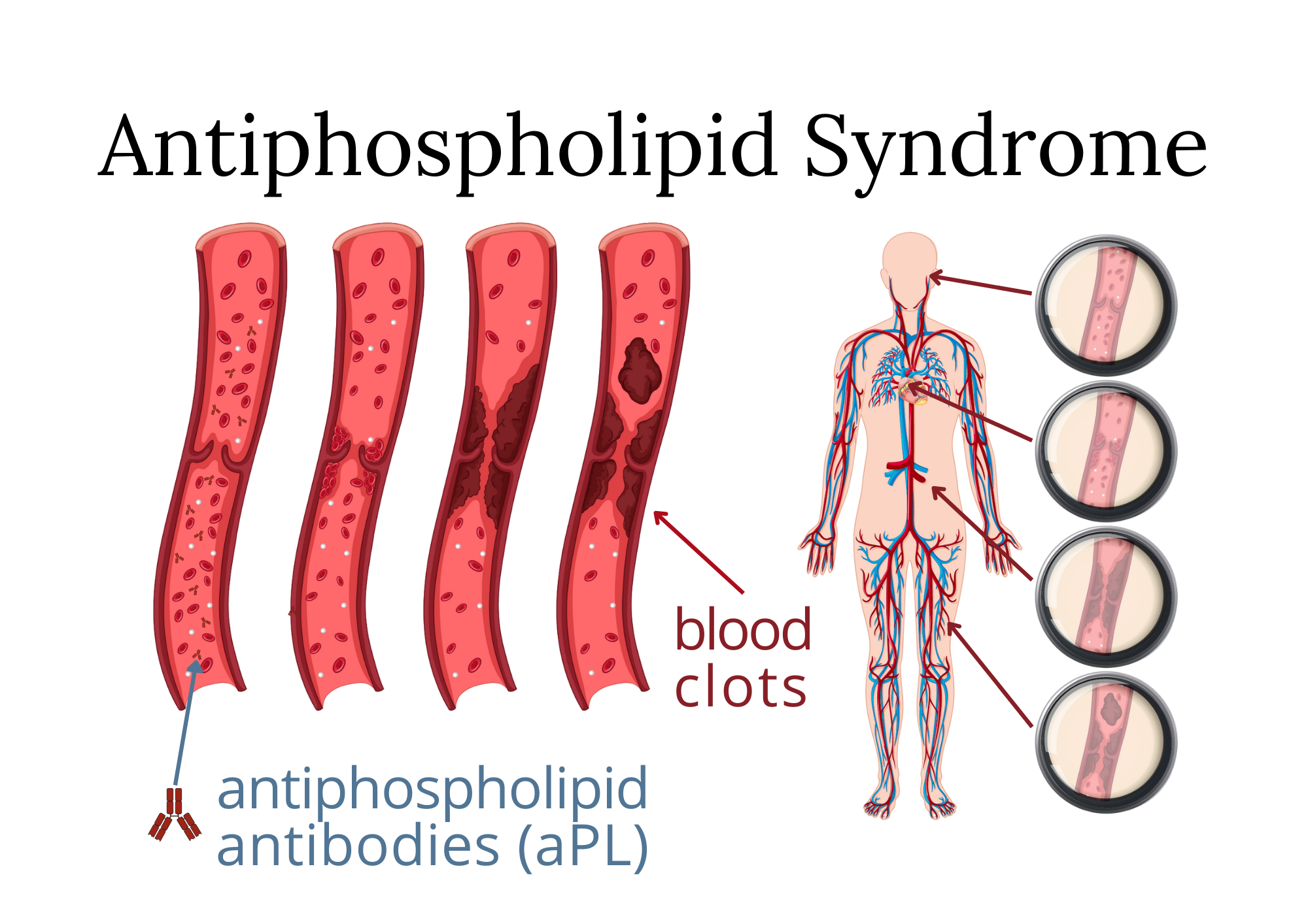 Aspirin Stroke Antiphospholipid Syndrome At Wilford Shaw Blog Aspirin Stroke Antiphospholipid Syndrome At Wilford Shaw Blog