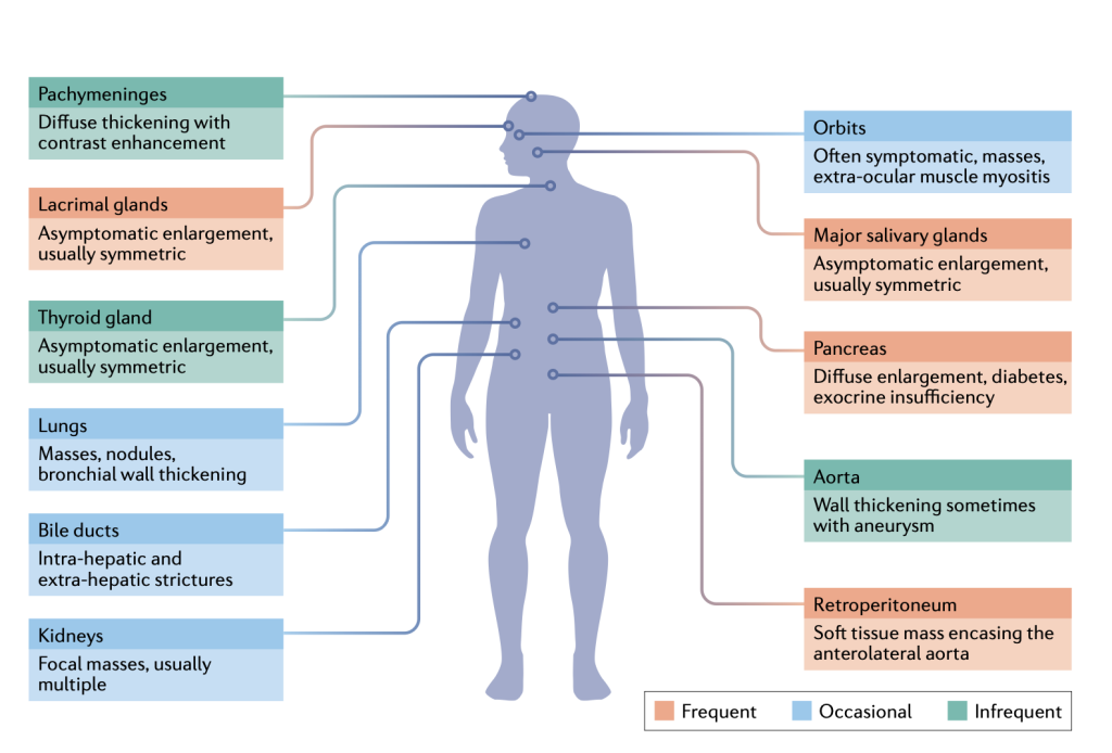 Disease IgG4 - ERN ReCONNET | European Reference Network on Rare and ...